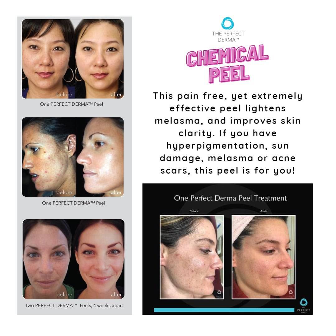 Perfect Derma Peel in Houston, TX | My Face Lady