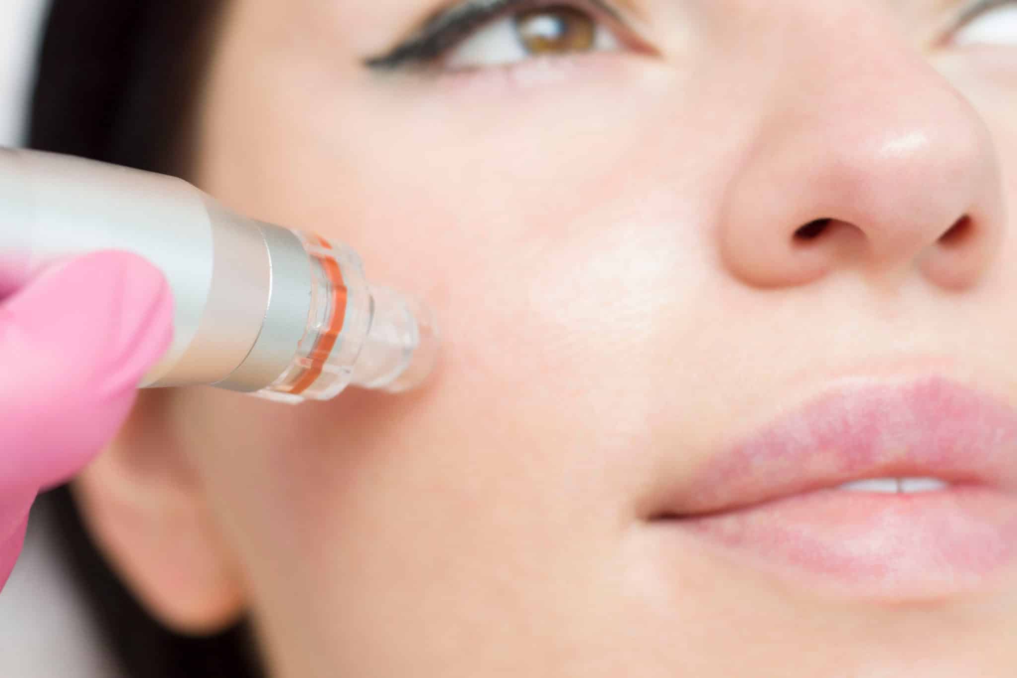 Does Microneedling Help Forehead Wrinkles?