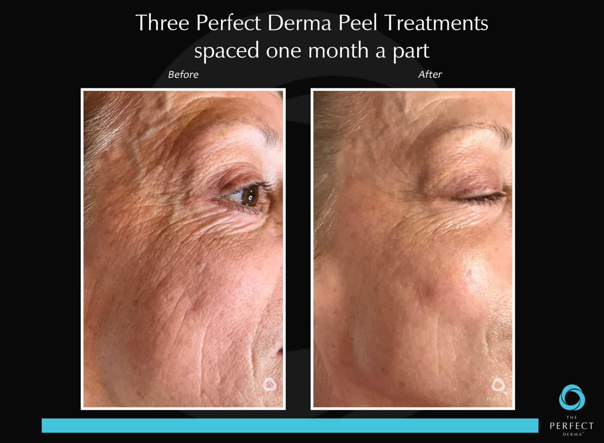 The Perfect Derma Peel - My Face Lady